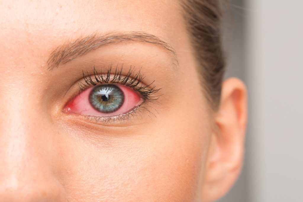 5 raisons qui expliquent les yeux rouges et les traitements | Vu